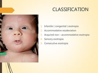 Esotropia by Ashith Tripathi | PPTX