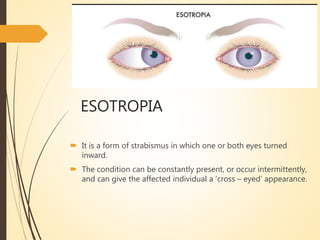 Esotropia by Ashith Tripathi | PPTX | Eye and Vision Conditions ...