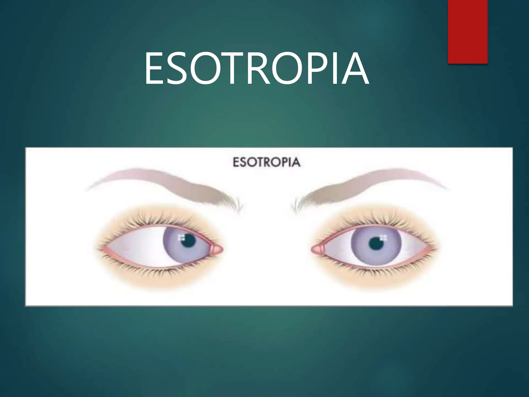 Esotropia ophthalmology presentation HSAH.pptx