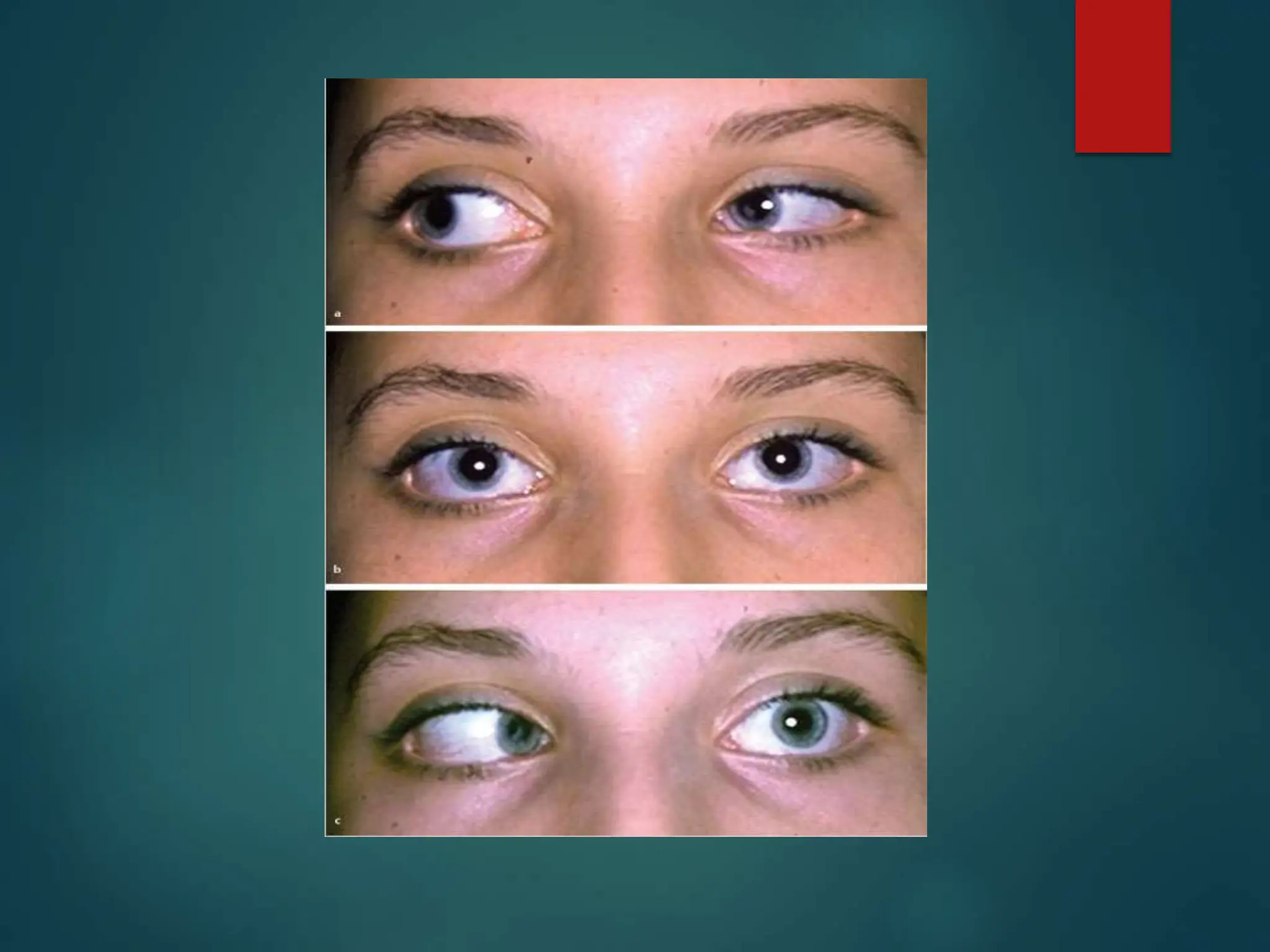 Esotropia ophthalmology presentation HSAH.pptx