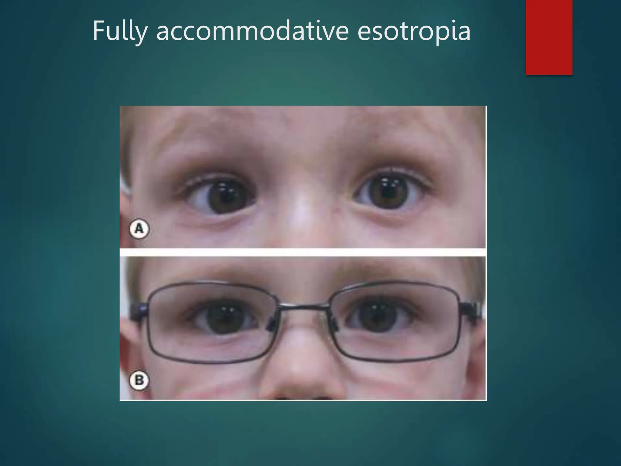 Esotropia ophthalmology presentation HSAH.pptx
