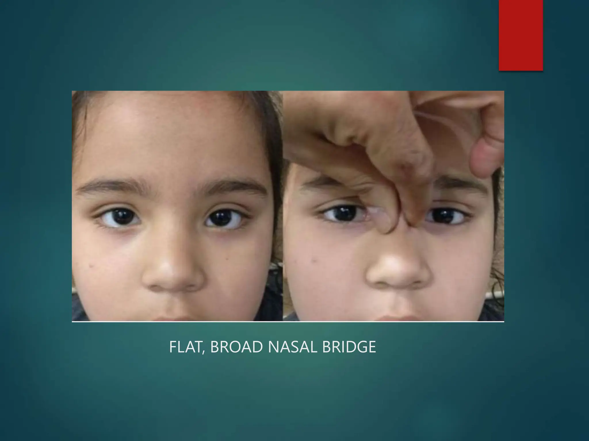 Esotropia ophthalmology presentation HSAH.pptx