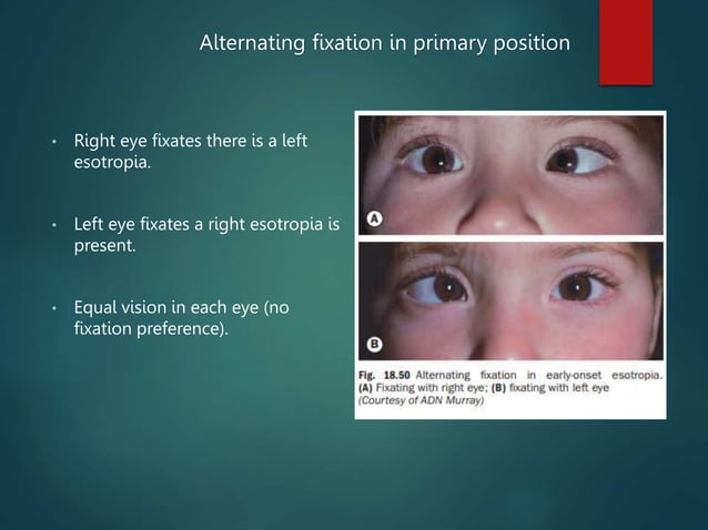 Esotropia ophthalmology presentation HSAH.pptx | Eye and Vision Conditions | Diseases and Conditions