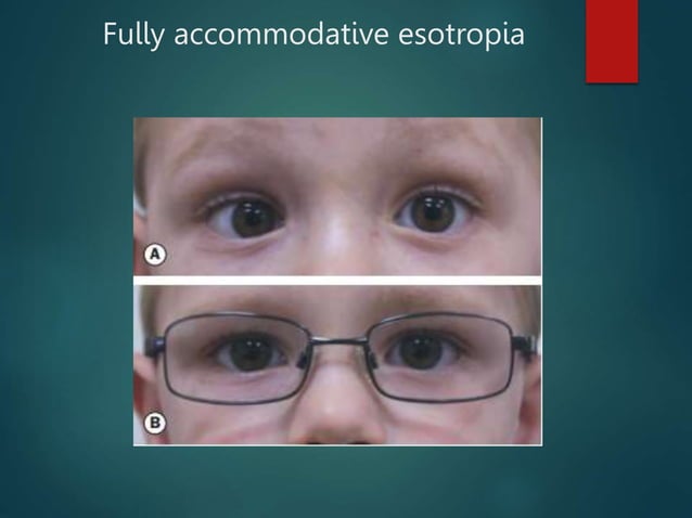 Esotropia ophthalmology presentation HSAH.pptx | Eye and Vision ...