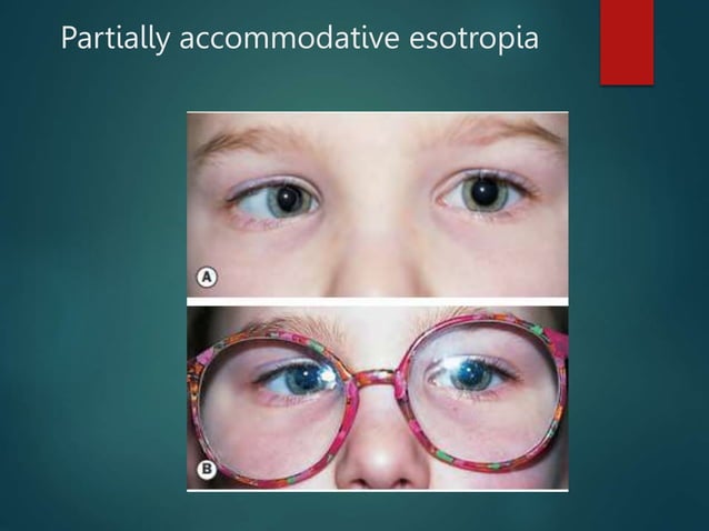 Esotropia ophthalmology presentation HSAH.pptx | Eye and Vision Conditions | Diseases and Conditions