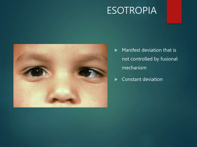 Esotropia ophthalmology presentation HSAH.pptx | Eye and Vision Conditions | Diseases and Conditions