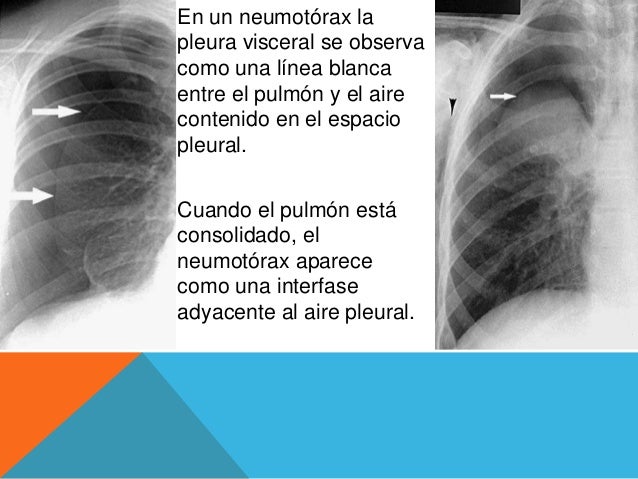 Espacio pleural y extrapleural