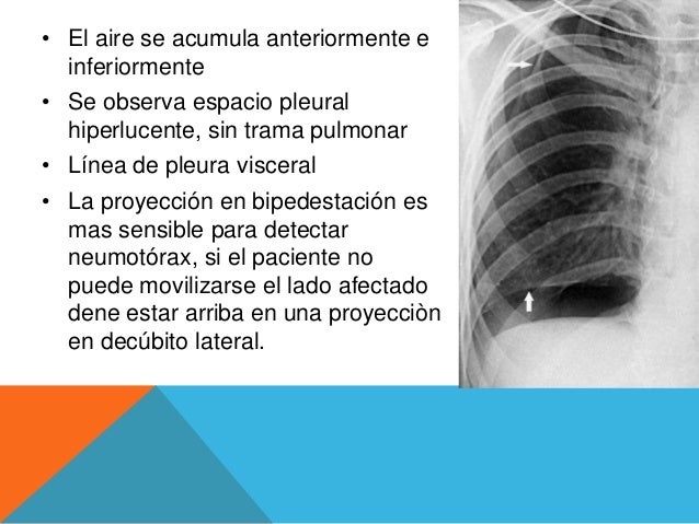 Espacio pleural y extrapleural