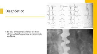 Espasmo esofagico difuso | PPTX
