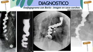 Espasmo esofagico difuso Gastroenterologia.pdf