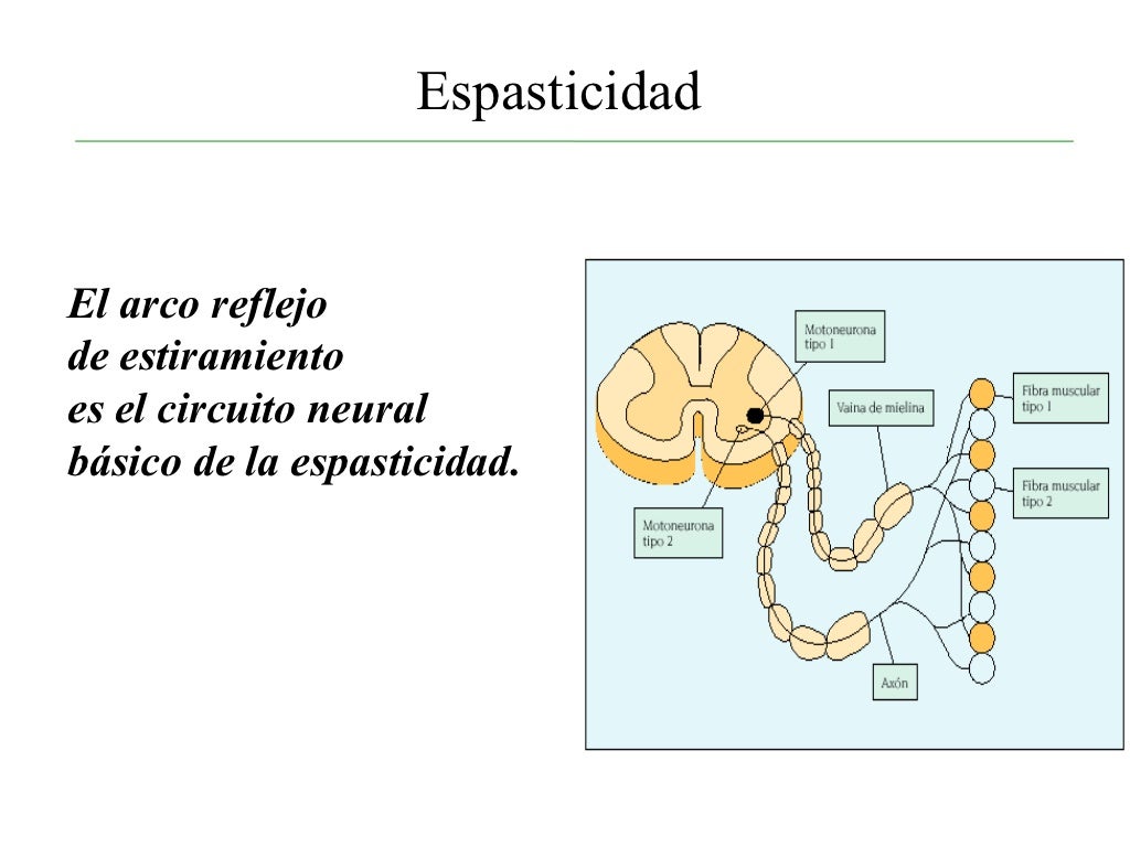 Espasticidad