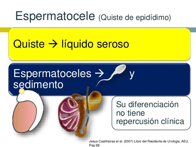 Espermatocele y varicocele