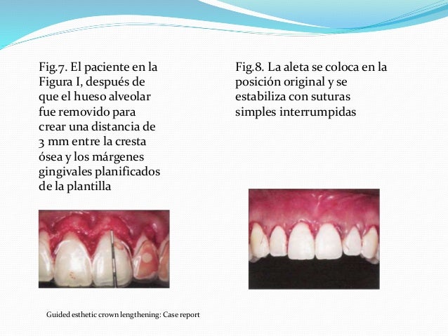 Espesor biológico, gingivectomía, bisel interno, bisel externo, alarg…