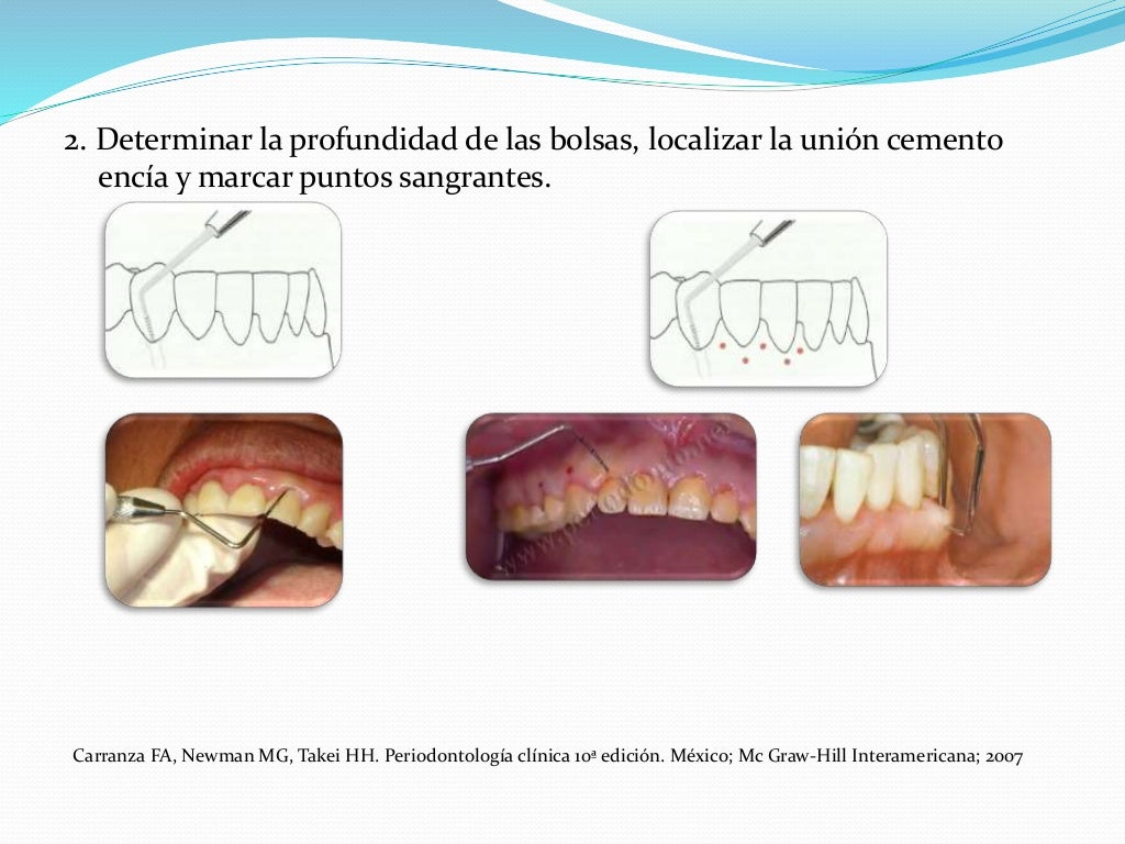 Espesor biológico, gingivectomía, bisel interno, bisel externo, alarg…