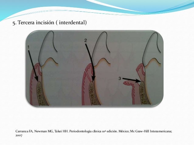 Espesor biológico, gingivectomía, bisel interno, bisel externo, alarg…