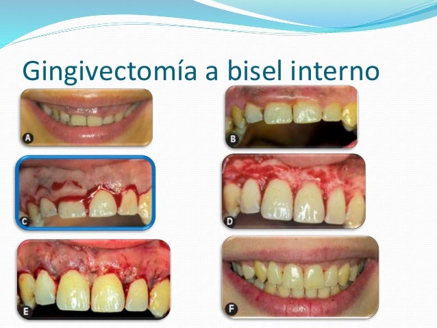 Espesor biológico, gingivectomía, bisel interno, bisel externo, alarg…