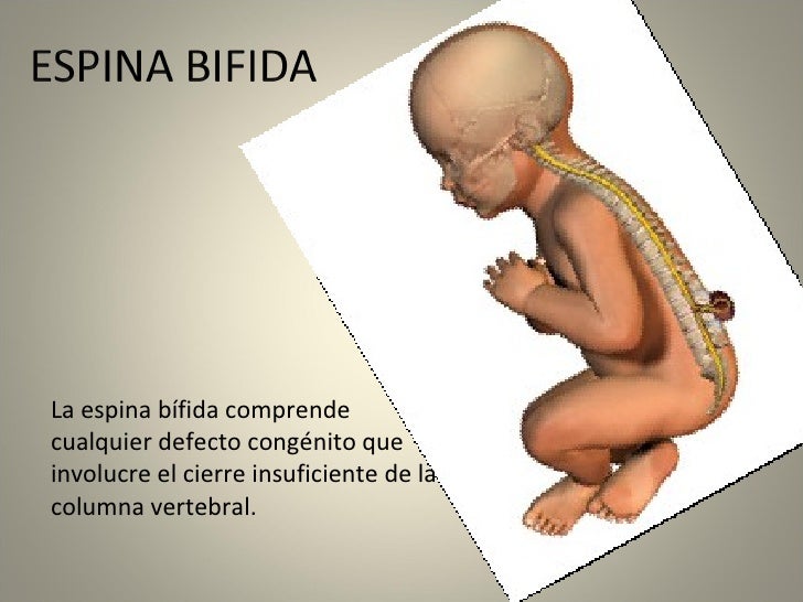 Espina bifida