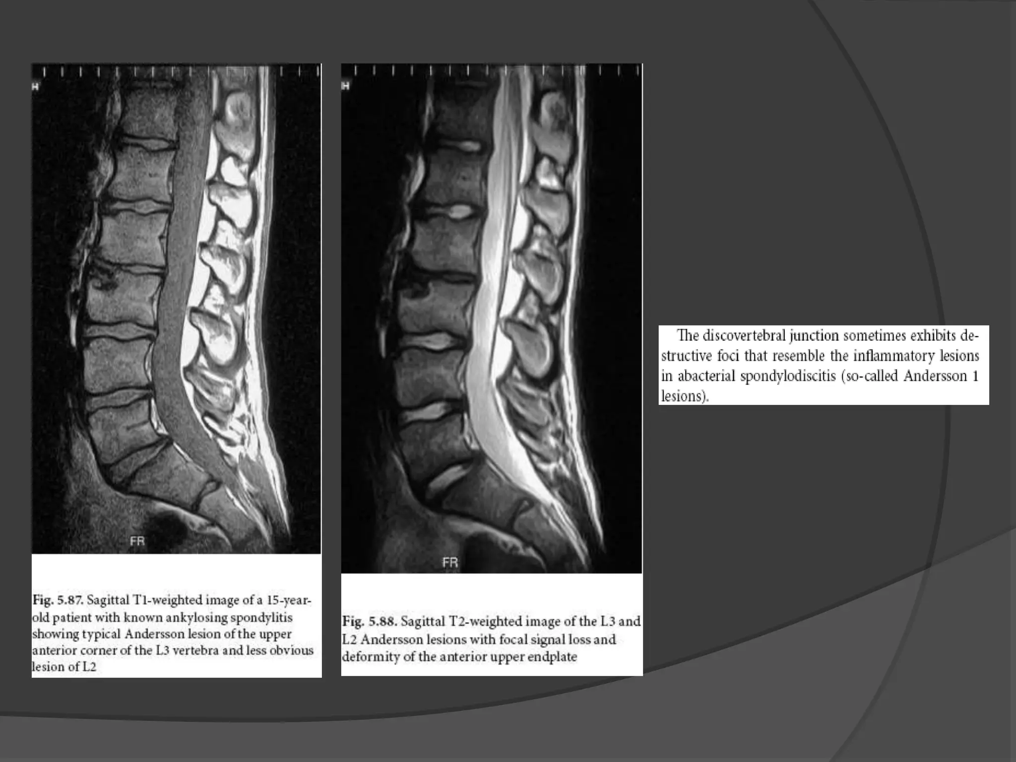 Espondilite anquilosante da coluna vertebral | PPT