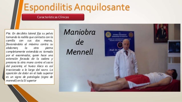 Espondilitis anquilosante