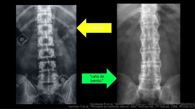 ESPONDILITIS ANQUILOSANTE