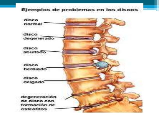 Espondiloartrosis, espondilolisis y espondilolistesis