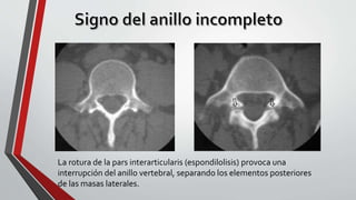 Espondilolistesis 1 | PPTX