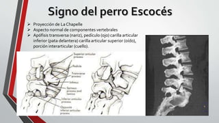 Espondilolistesis 1 | PPTX