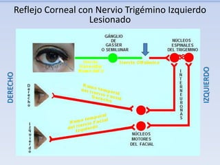 Esquema del reflexo corneal | PPSX