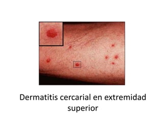 Esquistosomiasis | PPTX