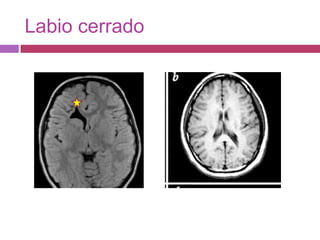 Esquizencefalia De Labios Cerrados