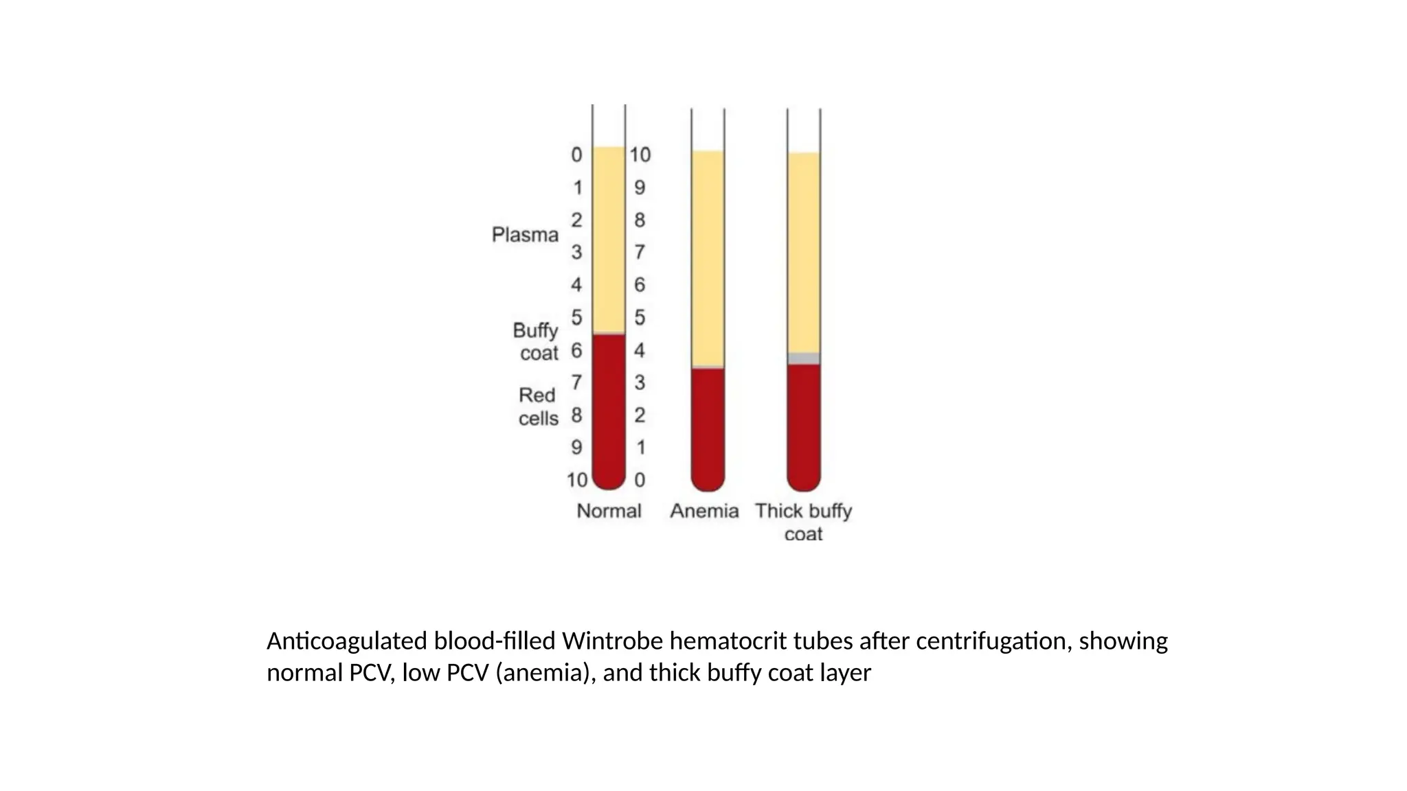 ESR, PCV and Buffy coat- Significance.pptx