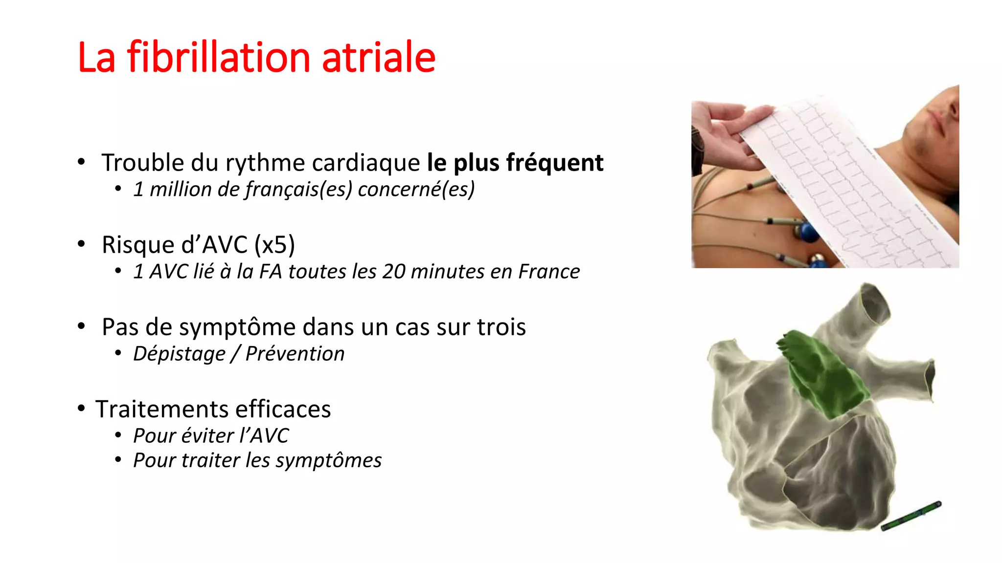 Fibrillation atriale | PPTX