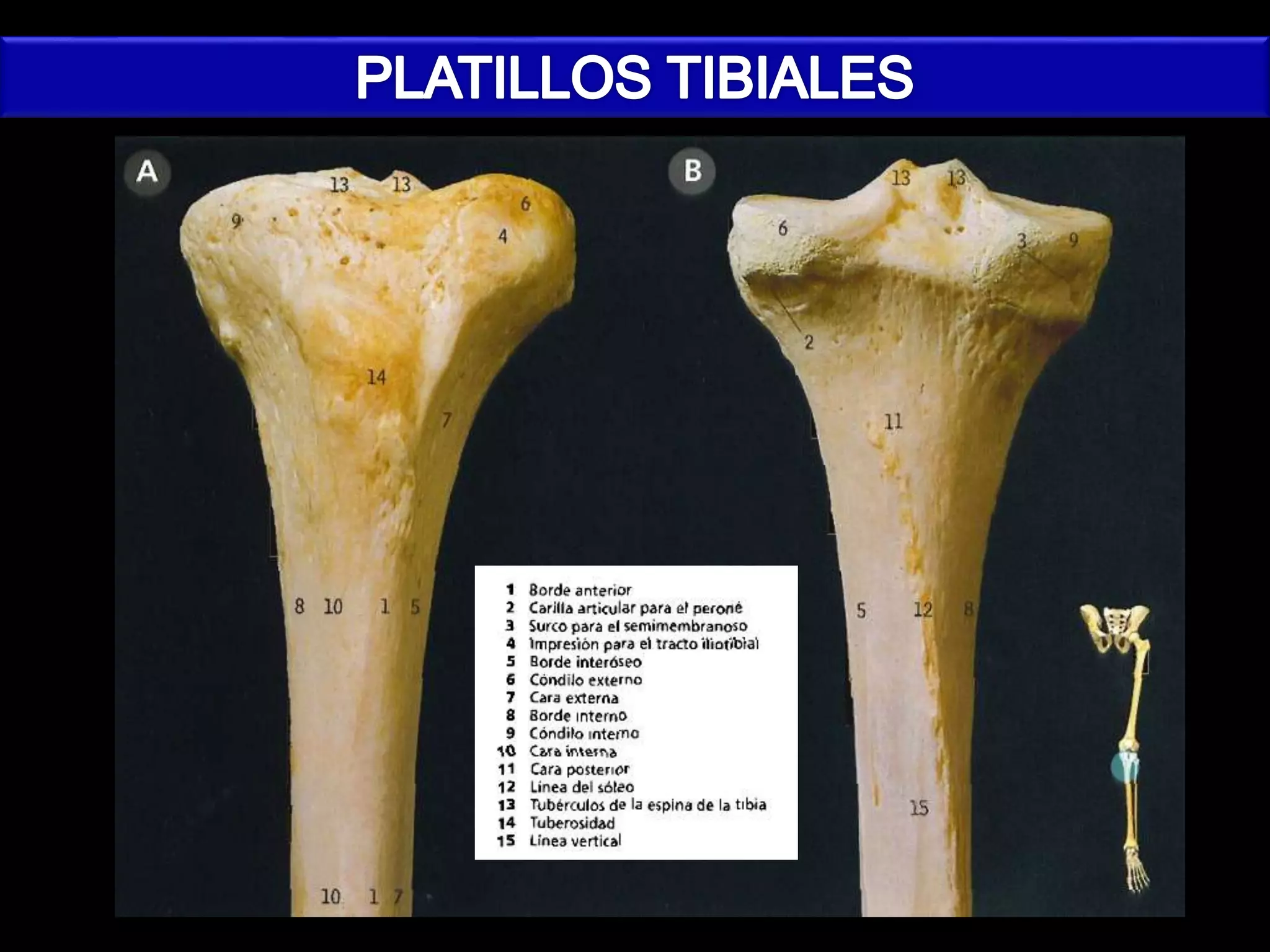 ESSALUD - FRACTURA DE PLATILLOS TIBIALES | PPTX