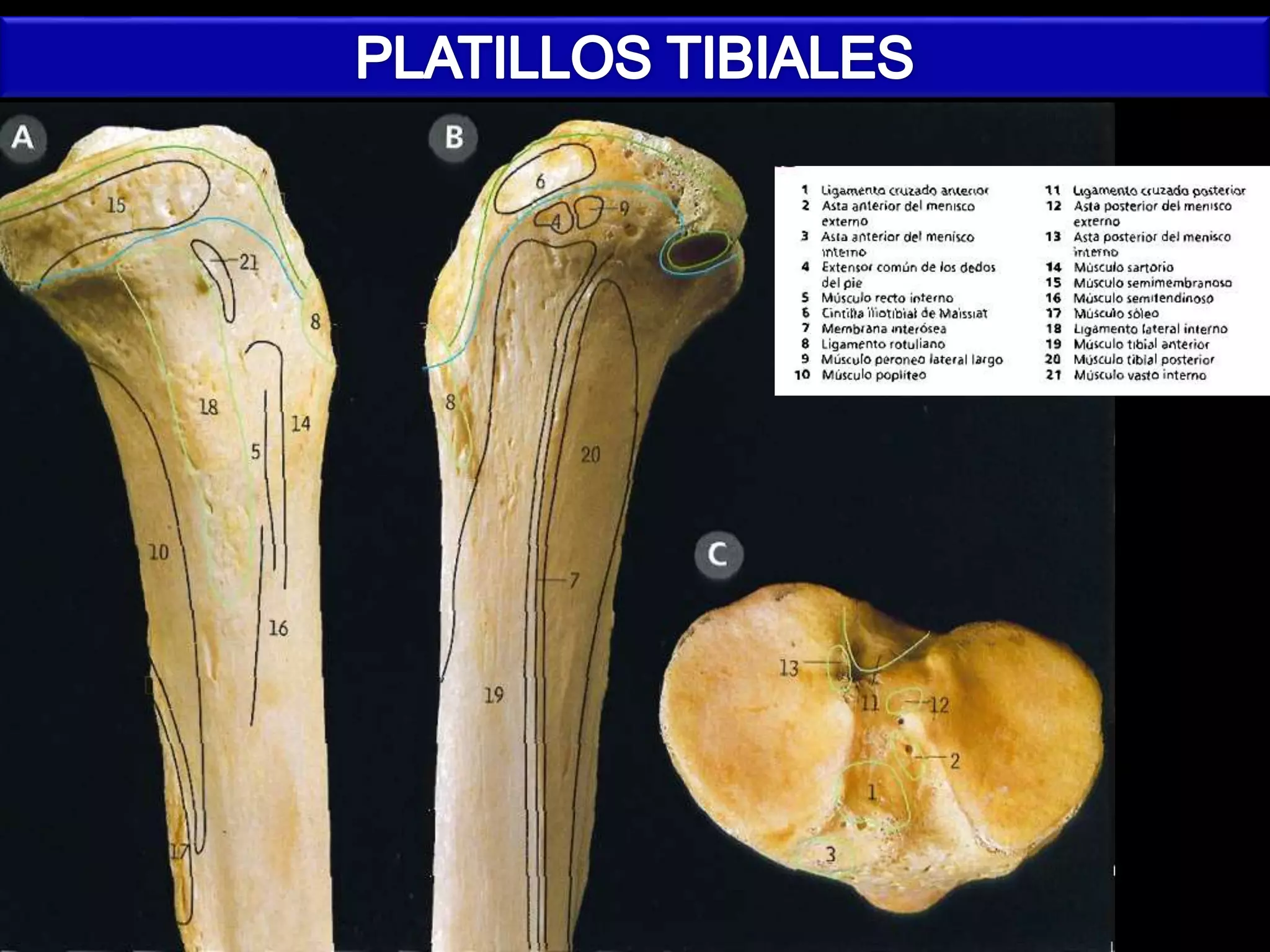 ESSALUD - FRACTURA DE PLATILLOS TIBIALES | PPTX