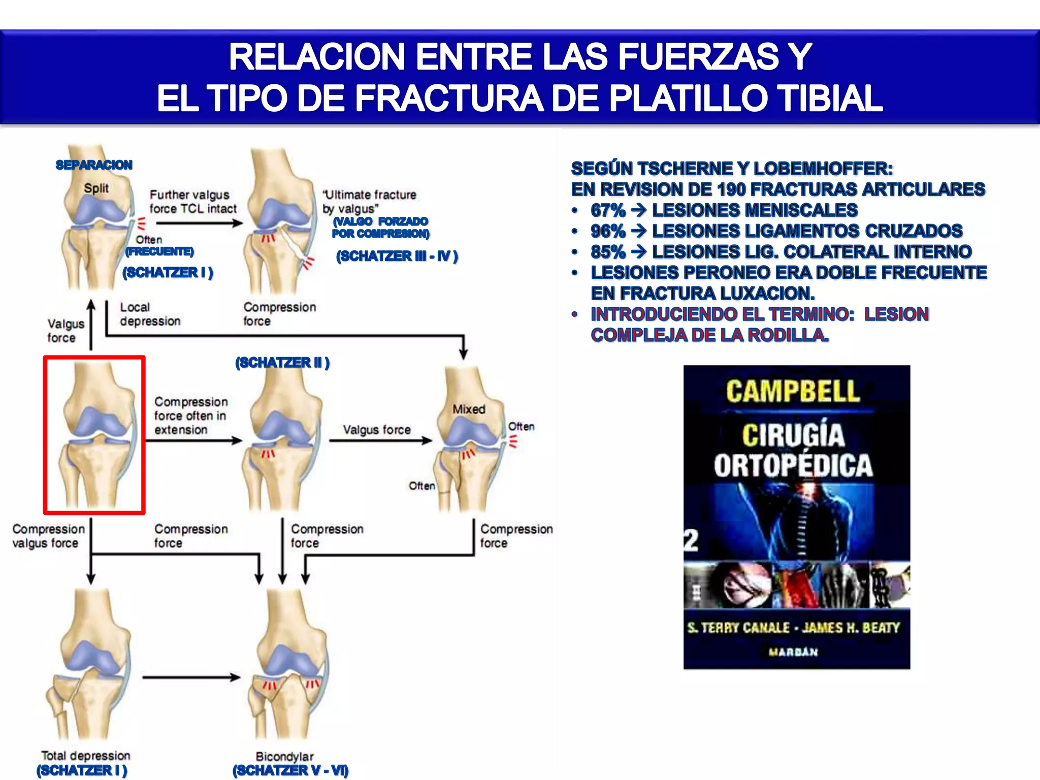 ESSALUD - FRACTURA DE PLATILLOS TIBIALES | PPTX