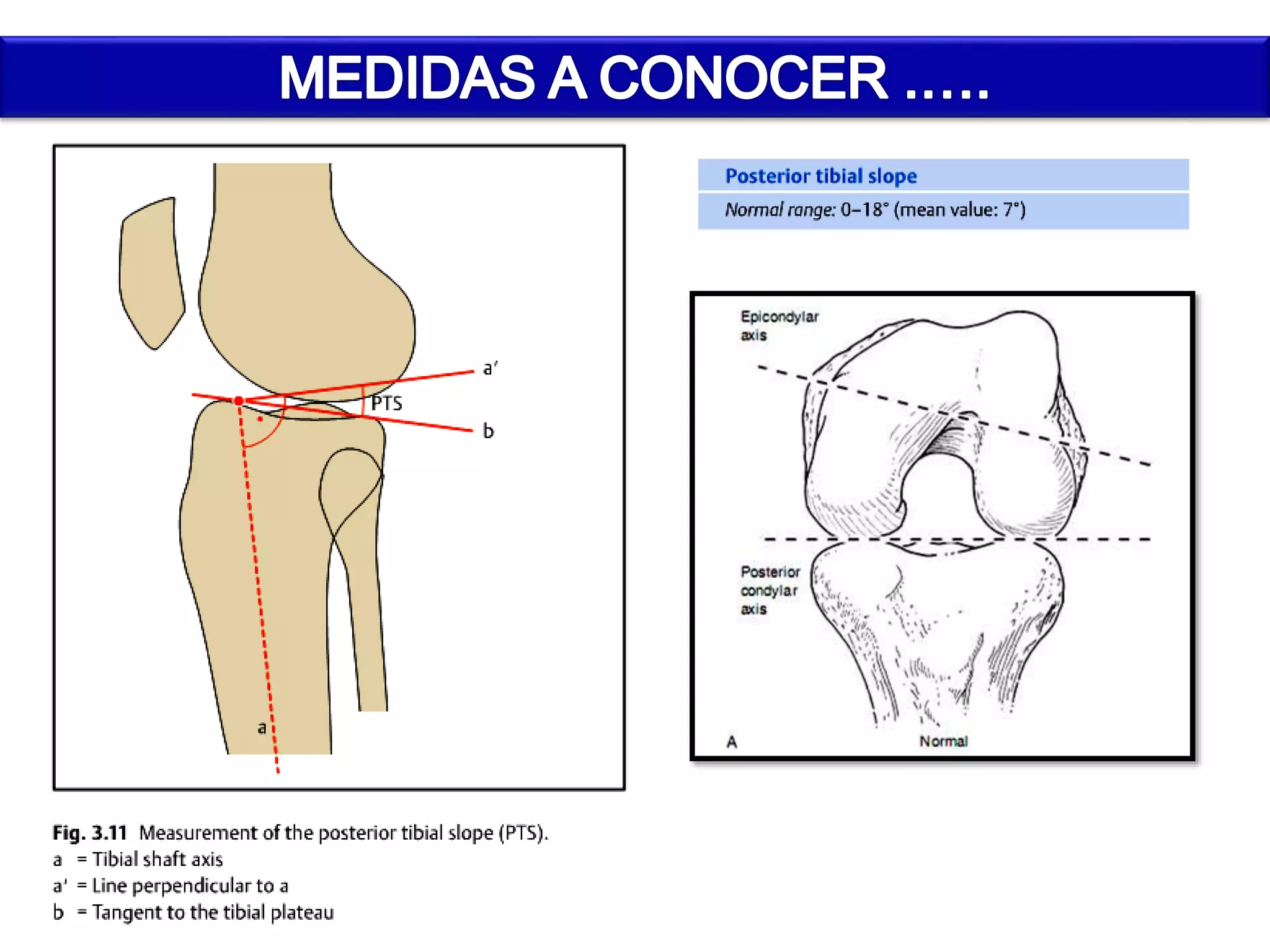ESSALUD - FRACTURA DE PLATILLOS TIBIALES | PPTX