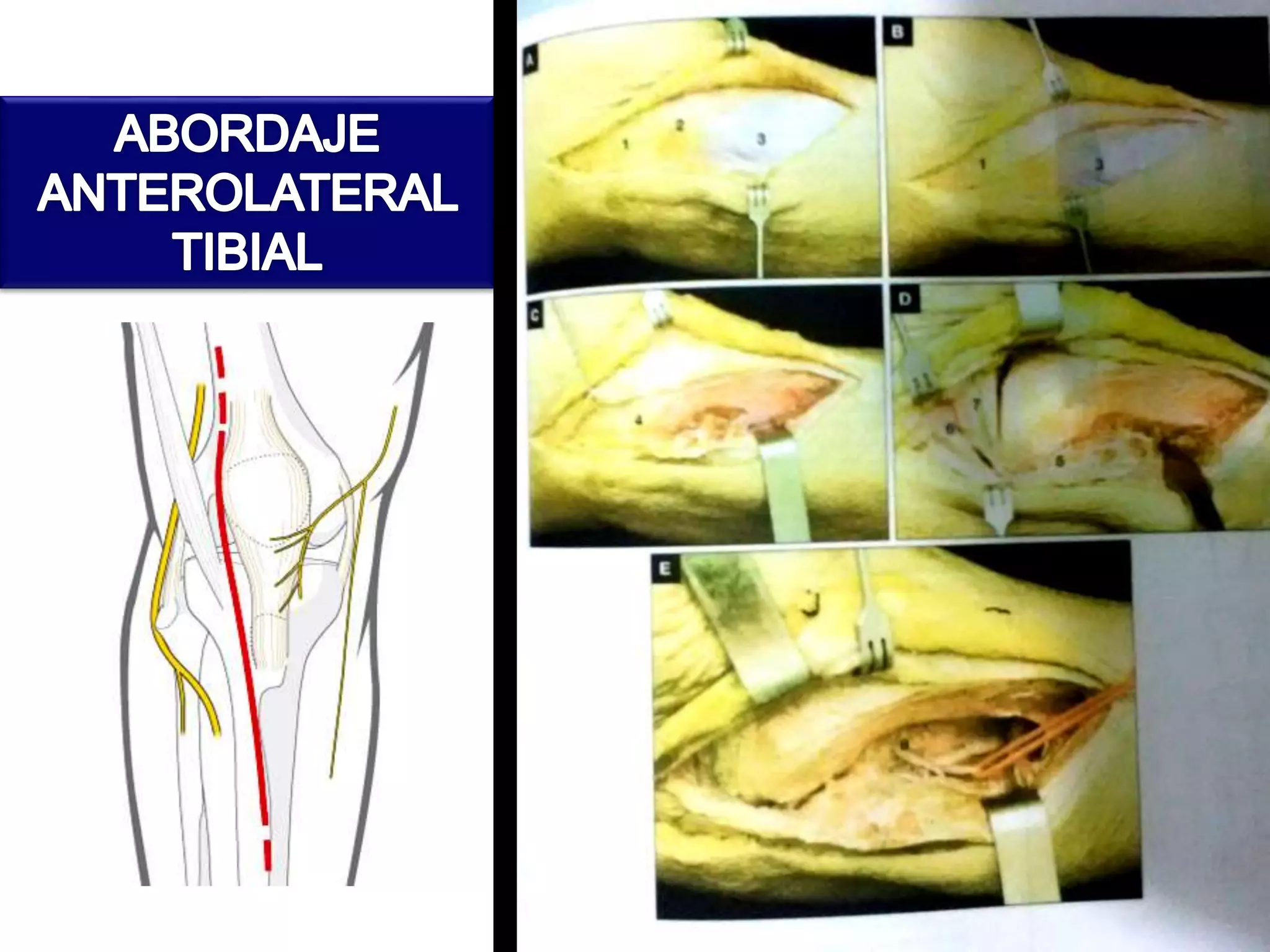 ESSALUD - FRACTURA DE PLATILLOS TIBIALES | PPTX