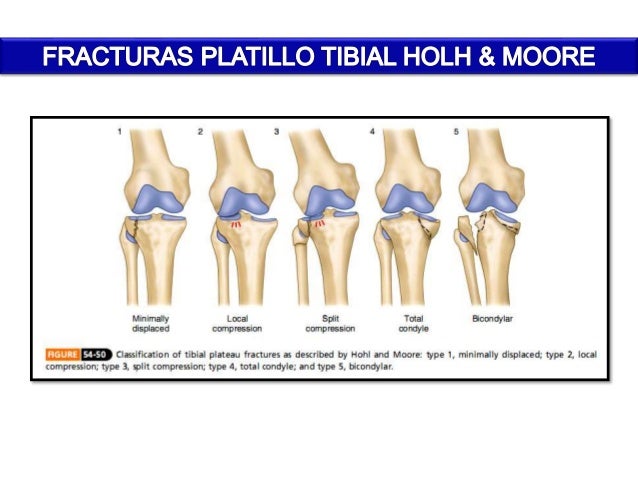 ESSALUD - FRACTURA DE PLATILLOS TIBIALES