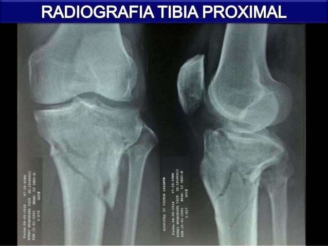 ESSALUD - FRACTURA DE PLATILLOS TIBIALES
