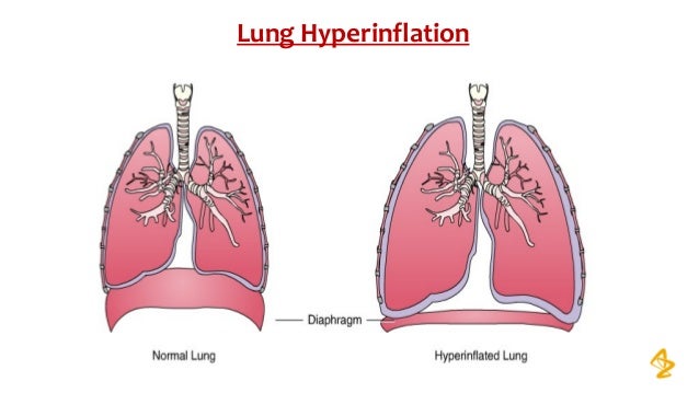 Role of Inhaled Corticosteroids in COPD
