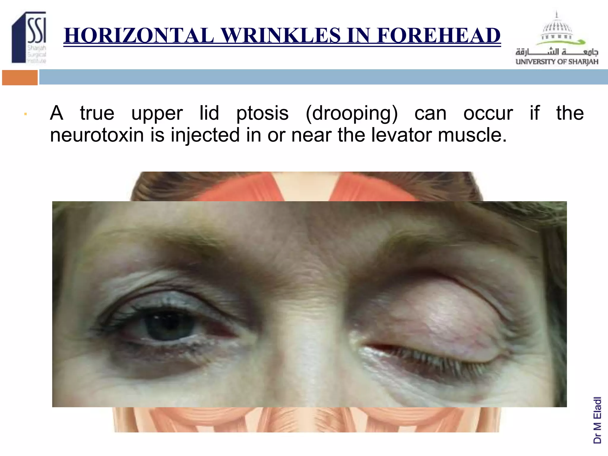 Essential anatomy for facial injections | PPTX
