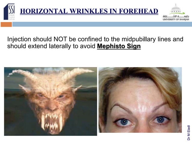 Essential anatomy for facial injections | PPTX