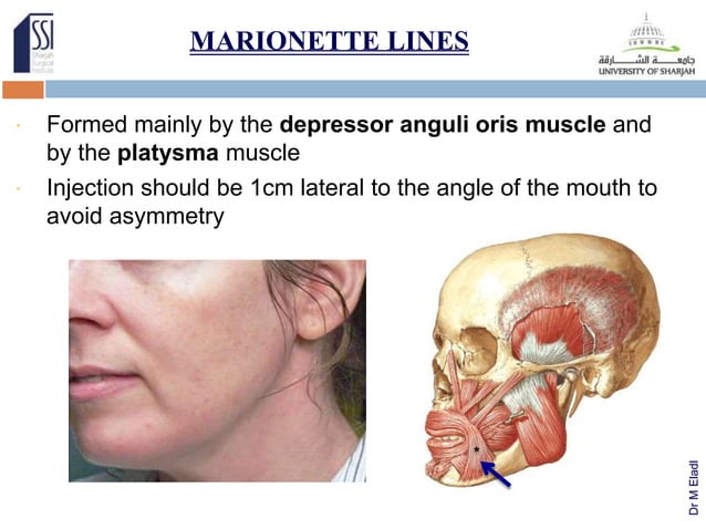 Essential anatomy for facial injections | PPTX