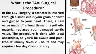 Essential Facts to Understand Before Undergoing a Transcatheter Aortic ...