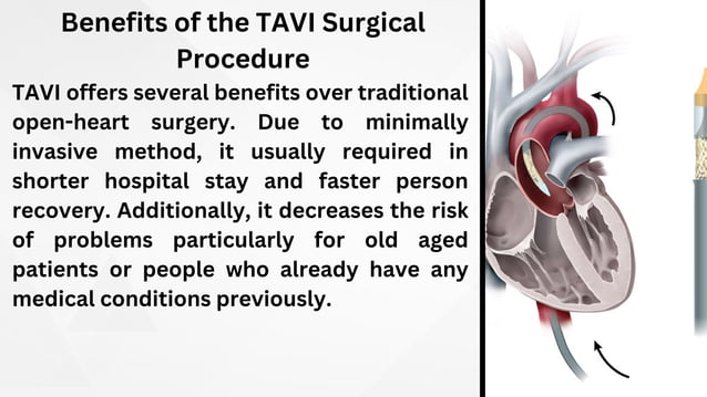 Essential Facts to Understand Before Undergoing a Transcatheter Aortic ...