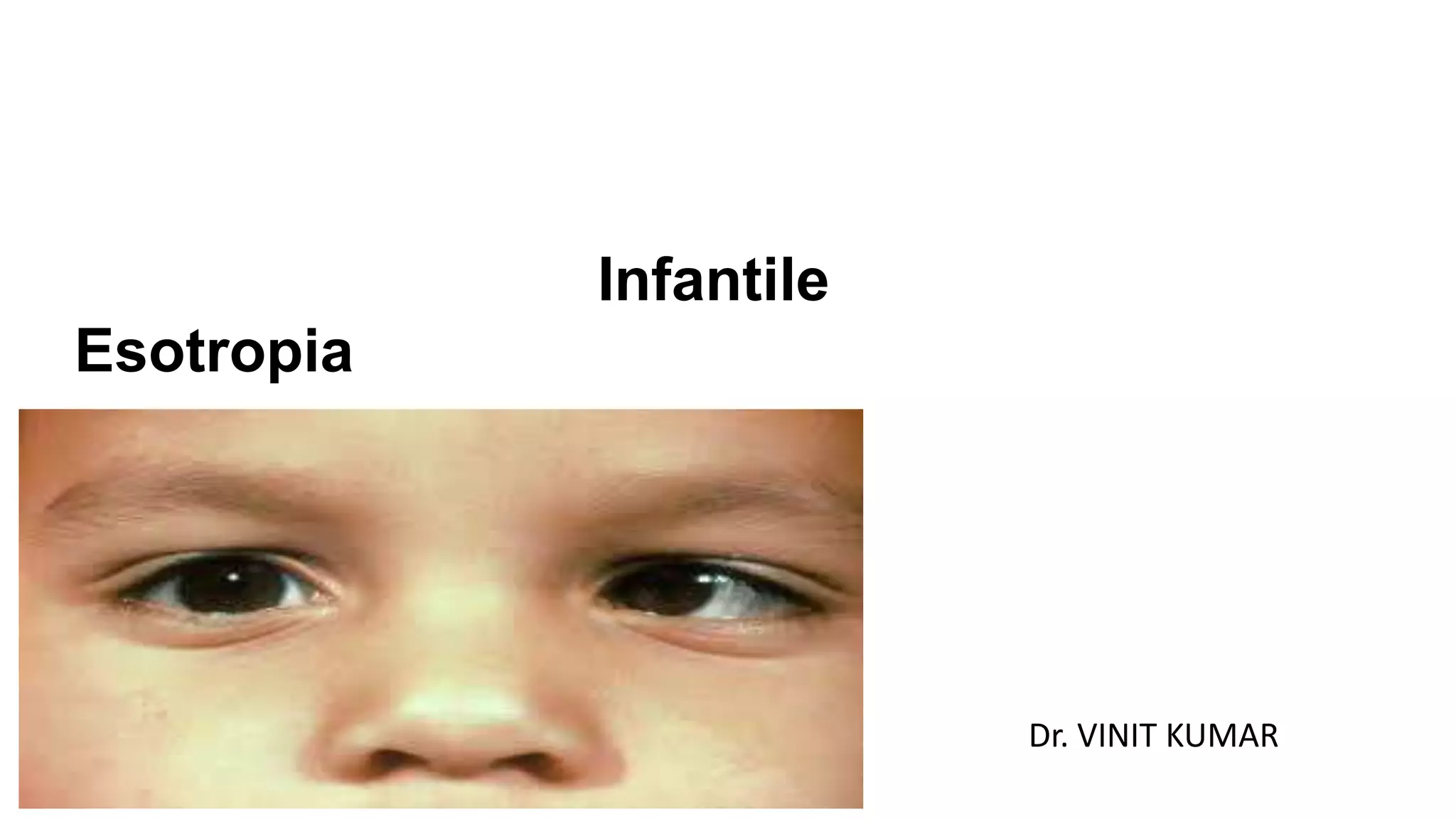 Essential infantile esotropia BY DR. VINIT KUMAR. Fellow Pediatric ...