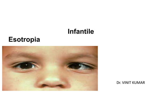 Essential infantile esotropia BY DR. VINIT KUMAR. Fellow Pediatric ...