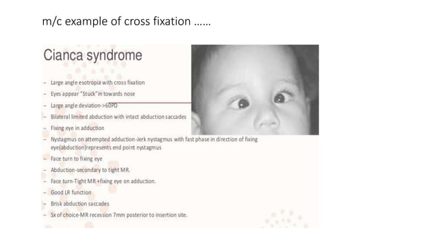 Essential infantile esotropia BY DR. VINIT KUMAR. Fellow Pediatric ...