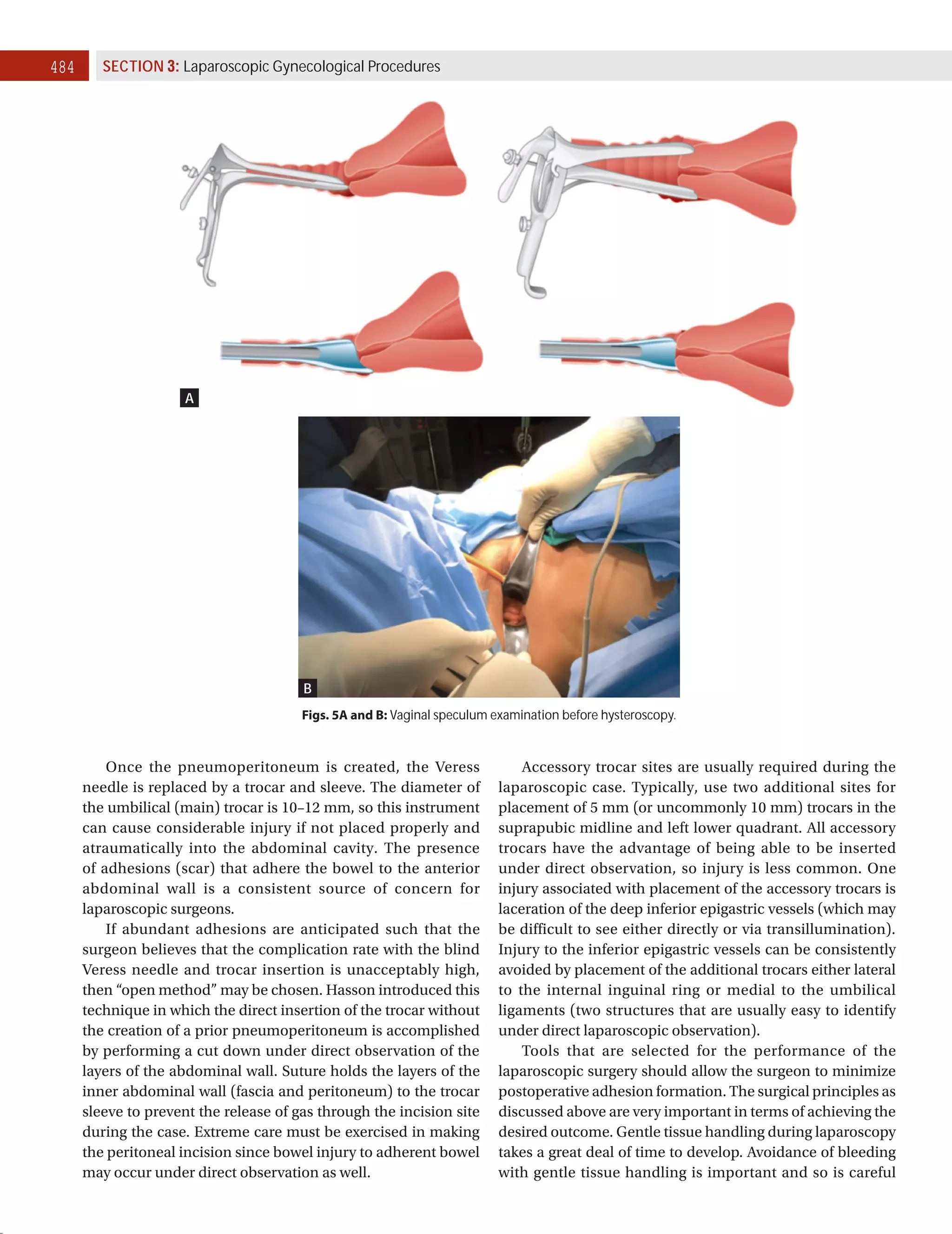Essentials of Hysteroscopy | PDF