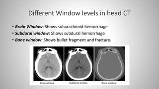 Essentials of CT brain (For Undergraduates) | PPTX